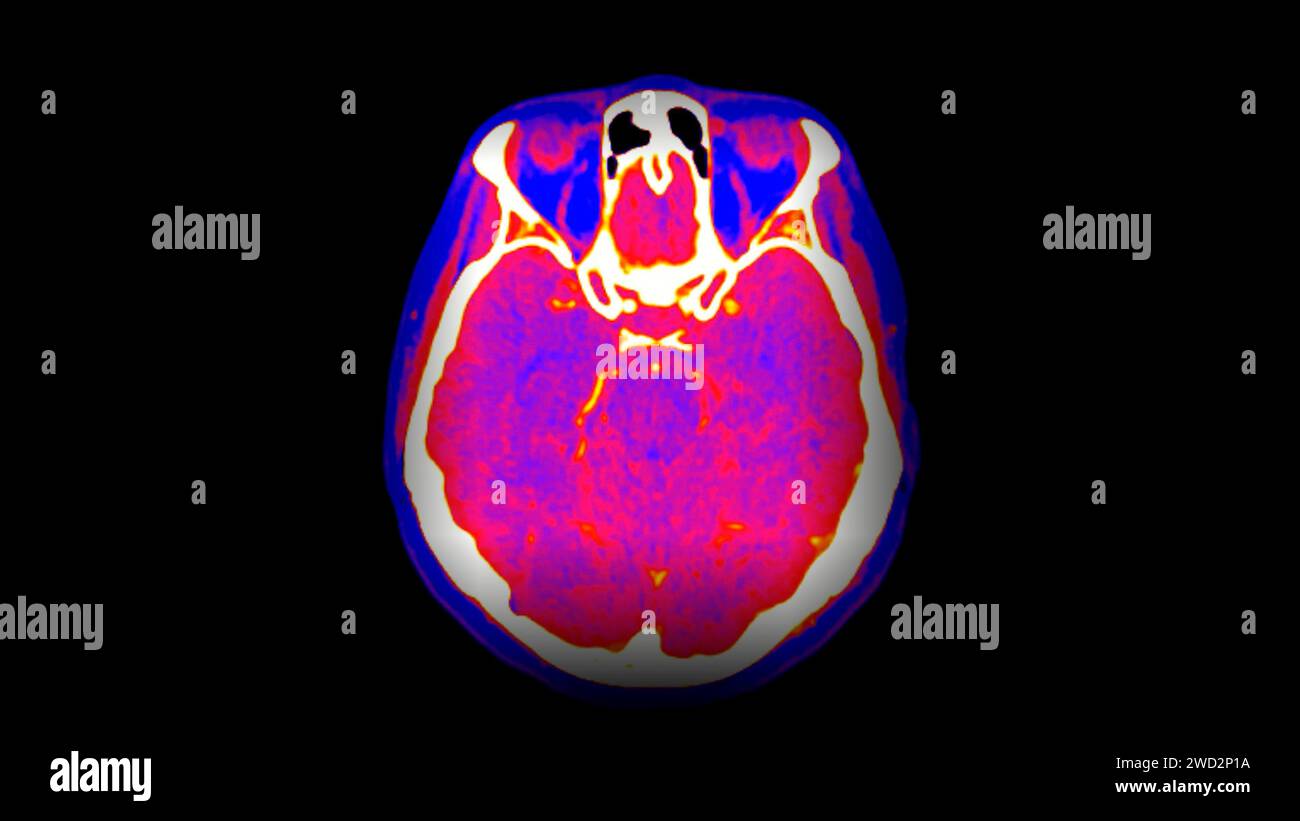 CT Brain Perfusion or CT scan image of the brain axial view Stock Photo ...