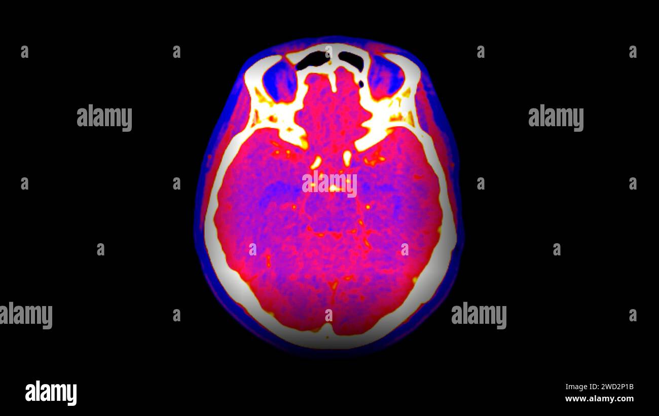 CT Brain Perfusion or CT scan image of the brain axial view Stock Photo ...