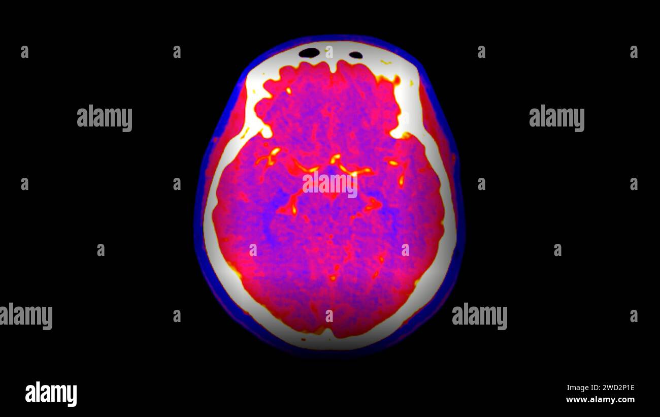 CT Brain Perfusion or CT scan image of the brain axial view Stock Photo ...