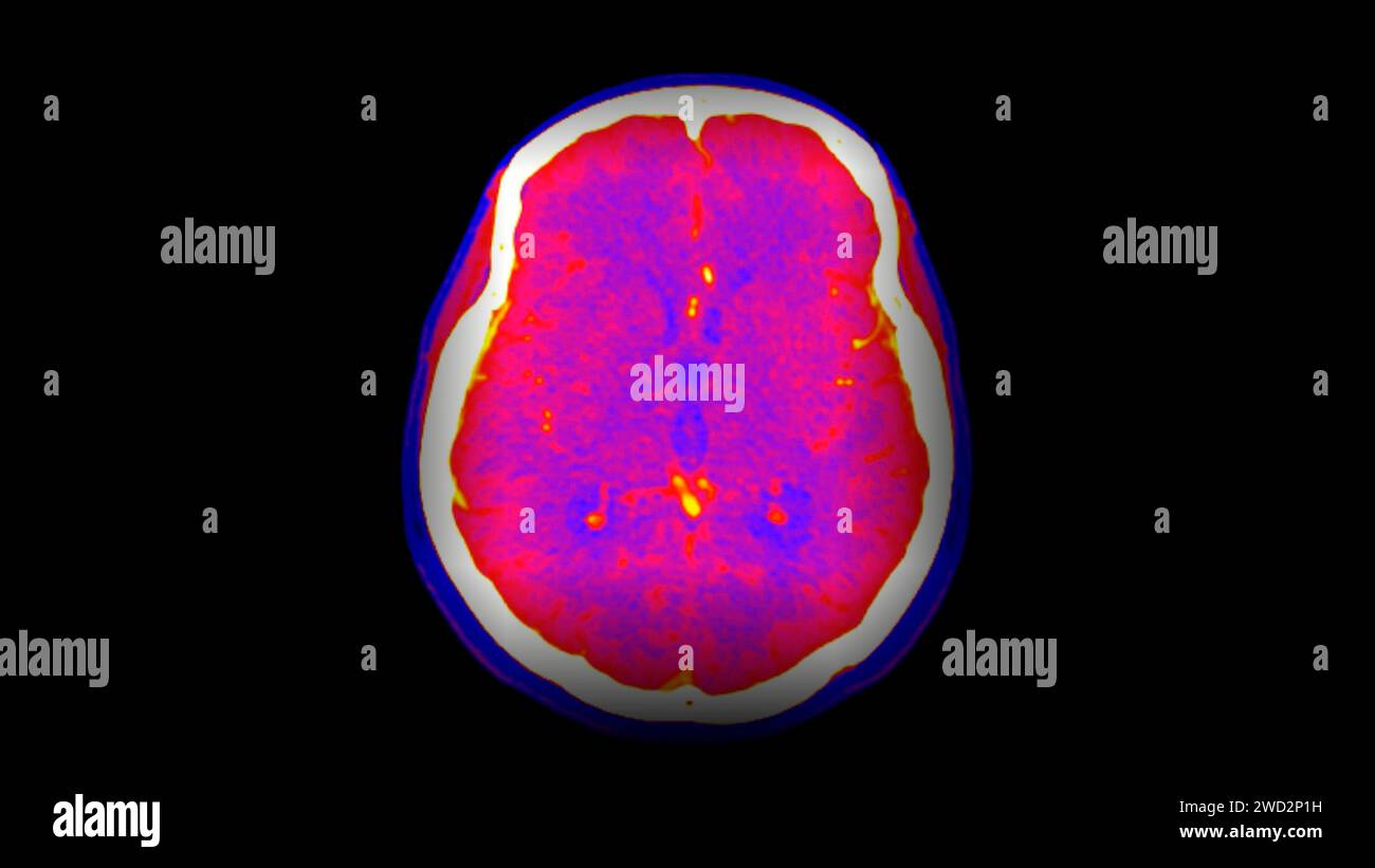 CT Brain Perfusion or CT scan image of the brain axial view Stock Photo ...