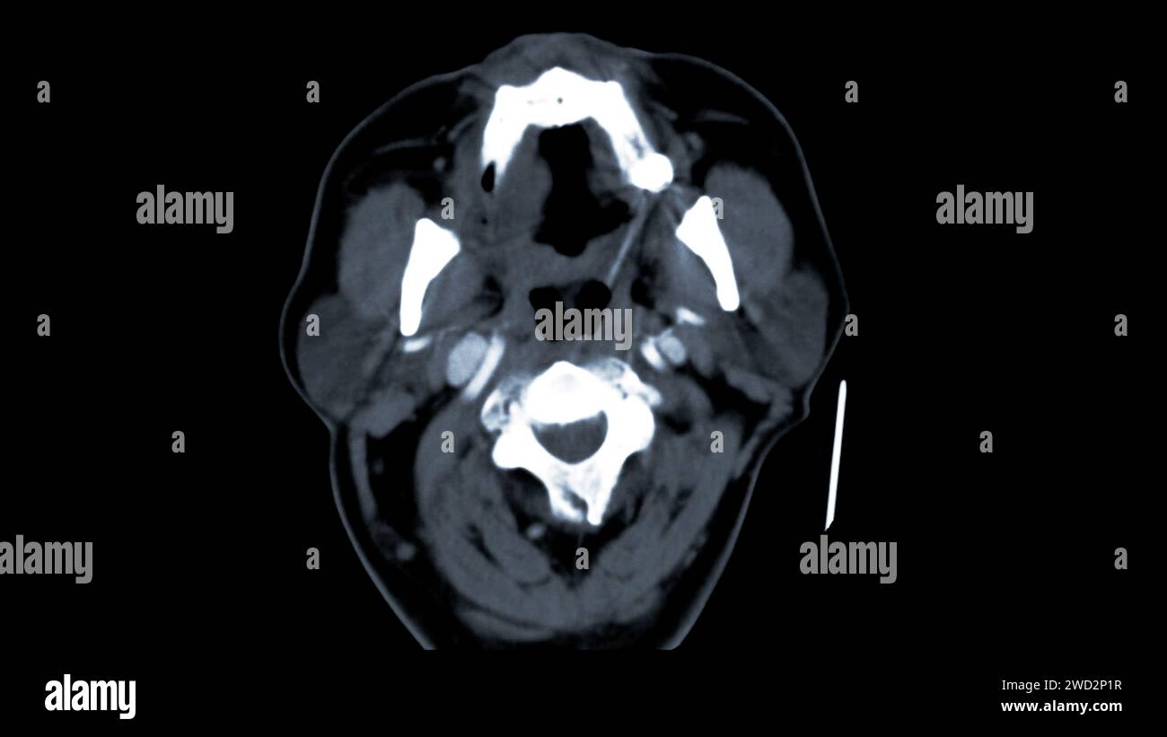 CT scan of the brain Axial view for diagnosis brain tumor,stroke ...