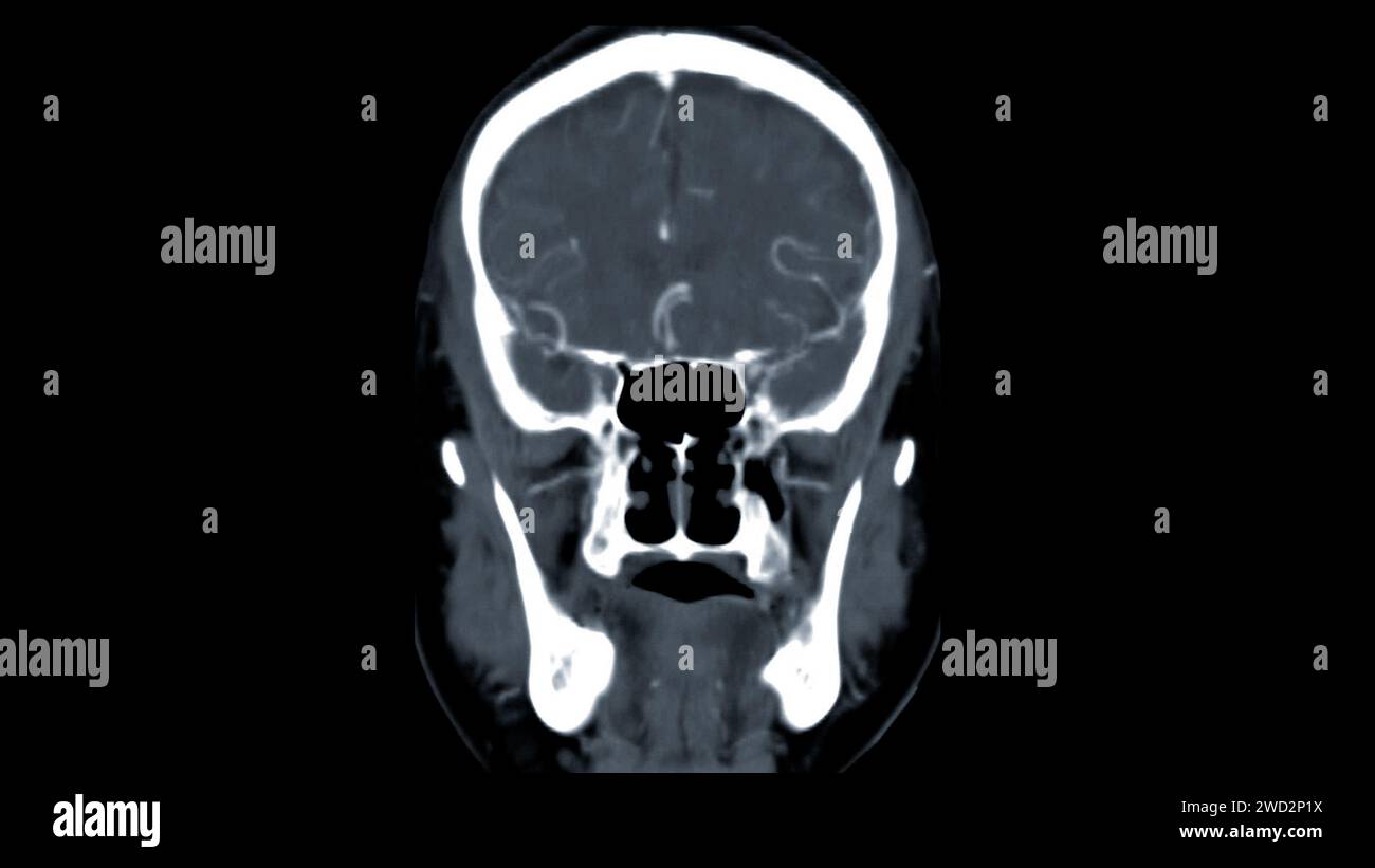 CT scan of the brain Coronal view for diagnosis brain tumor,stroke ...