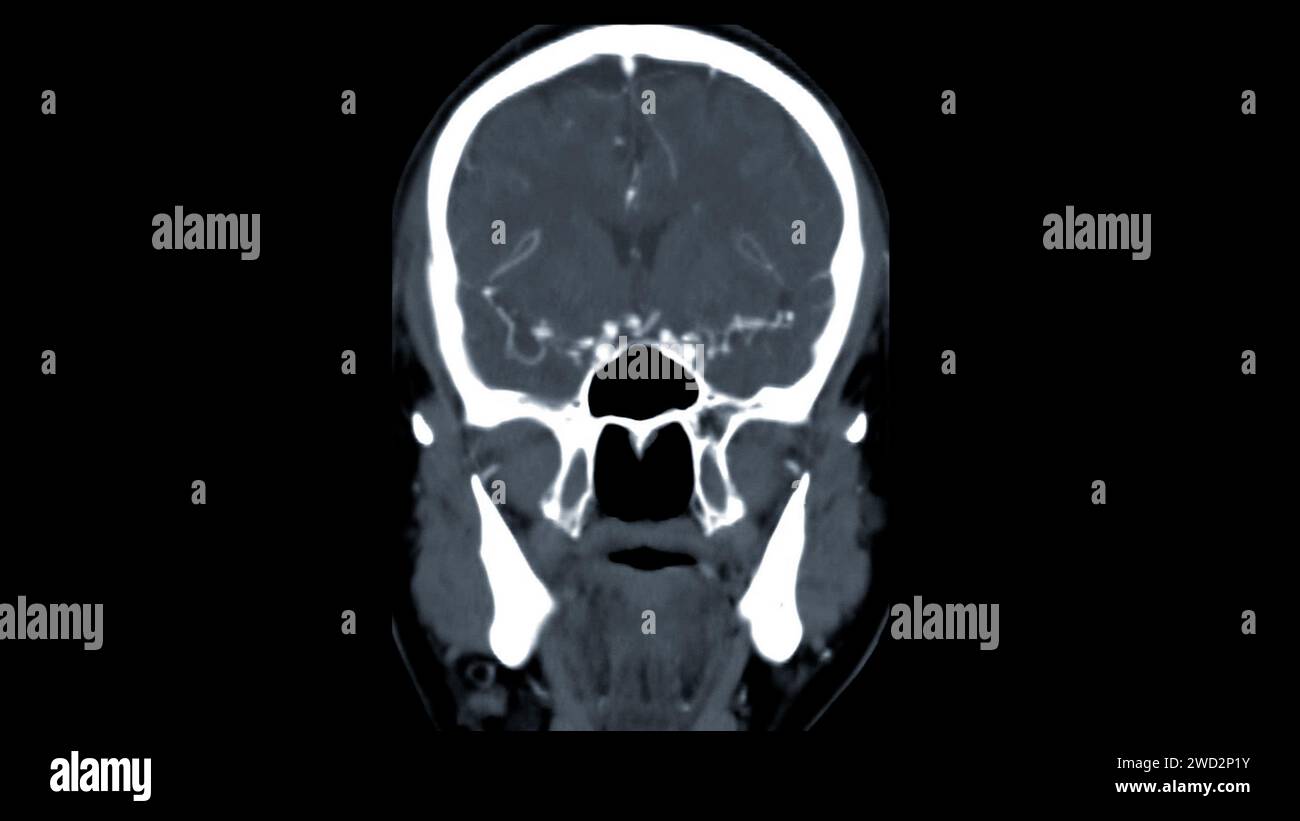 CT scan of the brain Coronal view for diagnosis brain tumor,stroke ...