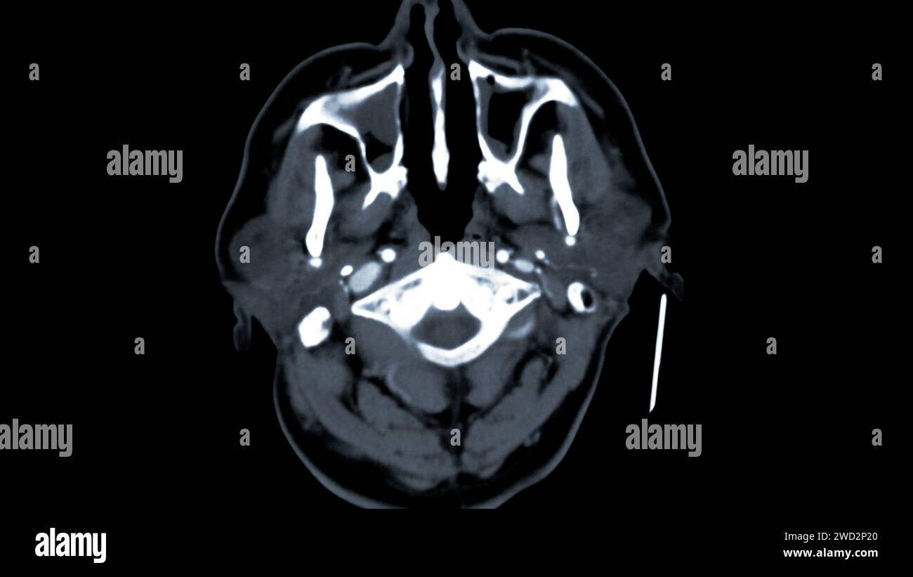 CT scan of the brain Axial view for diagnosis brain tumor,stroke ...