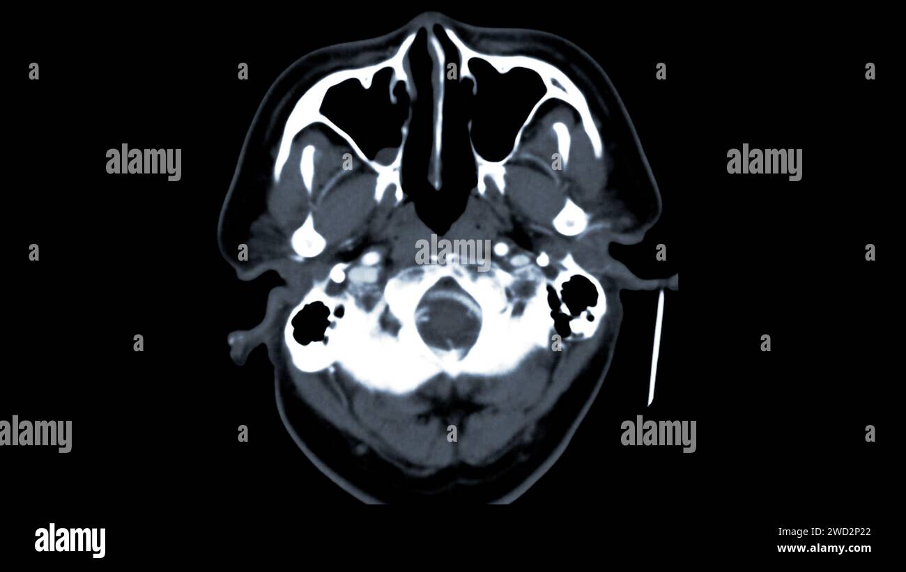CT scan of the brain Axial view for diagnosis brain tumor,stroke ...