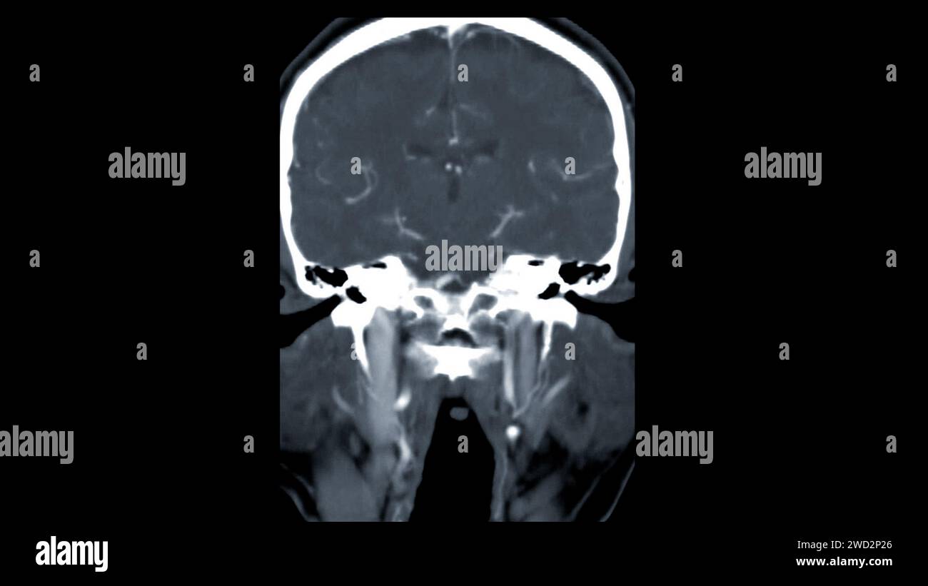 CT scan of the brain Coronal view for diagnosis brain tumor,stroke diseases and vascular ...