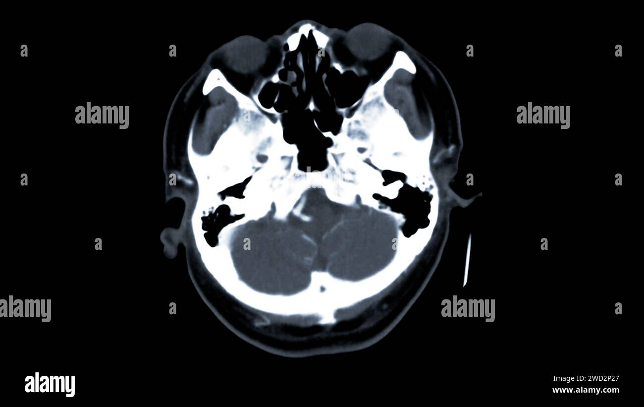 CT scan of the brain Axial view for diagnosis brain tumor,stroke ...
