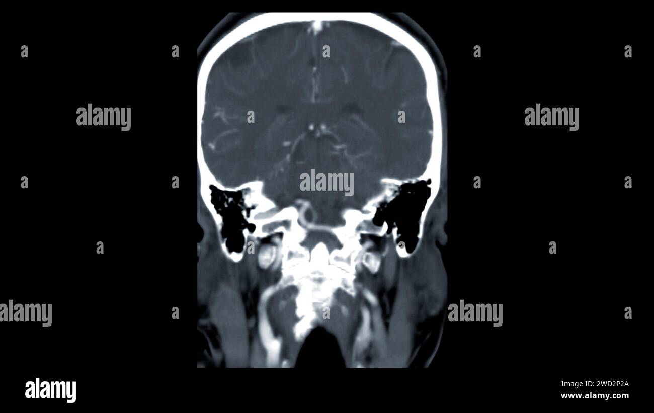 CT scan of the brain Coronal view for diagnosis brain tumor,stroke ...