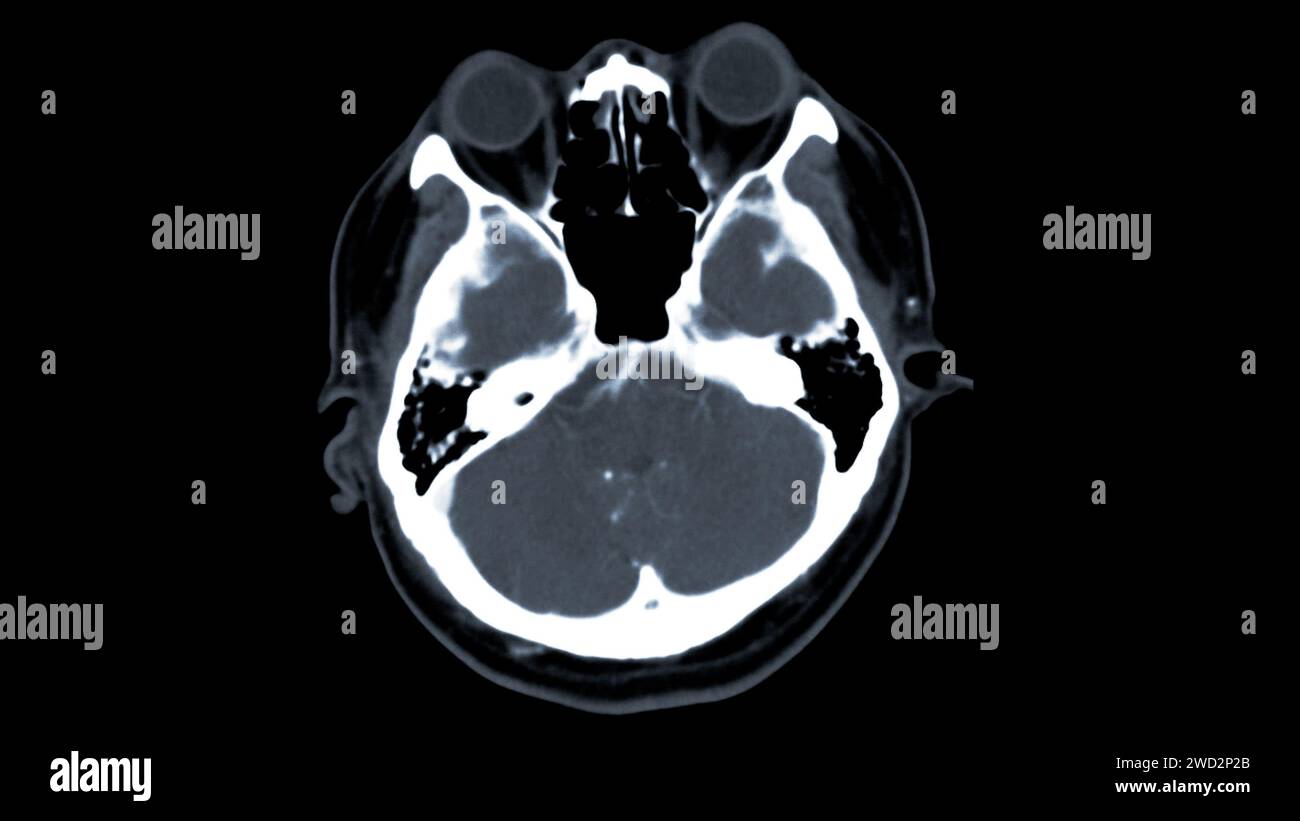 CT scan of the brain Axial view for diagnosis brain tumor,stroke ...