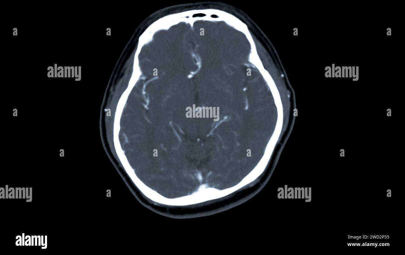 CT scan of the brain Axial view for diagnosis brain tumor,stroke ...