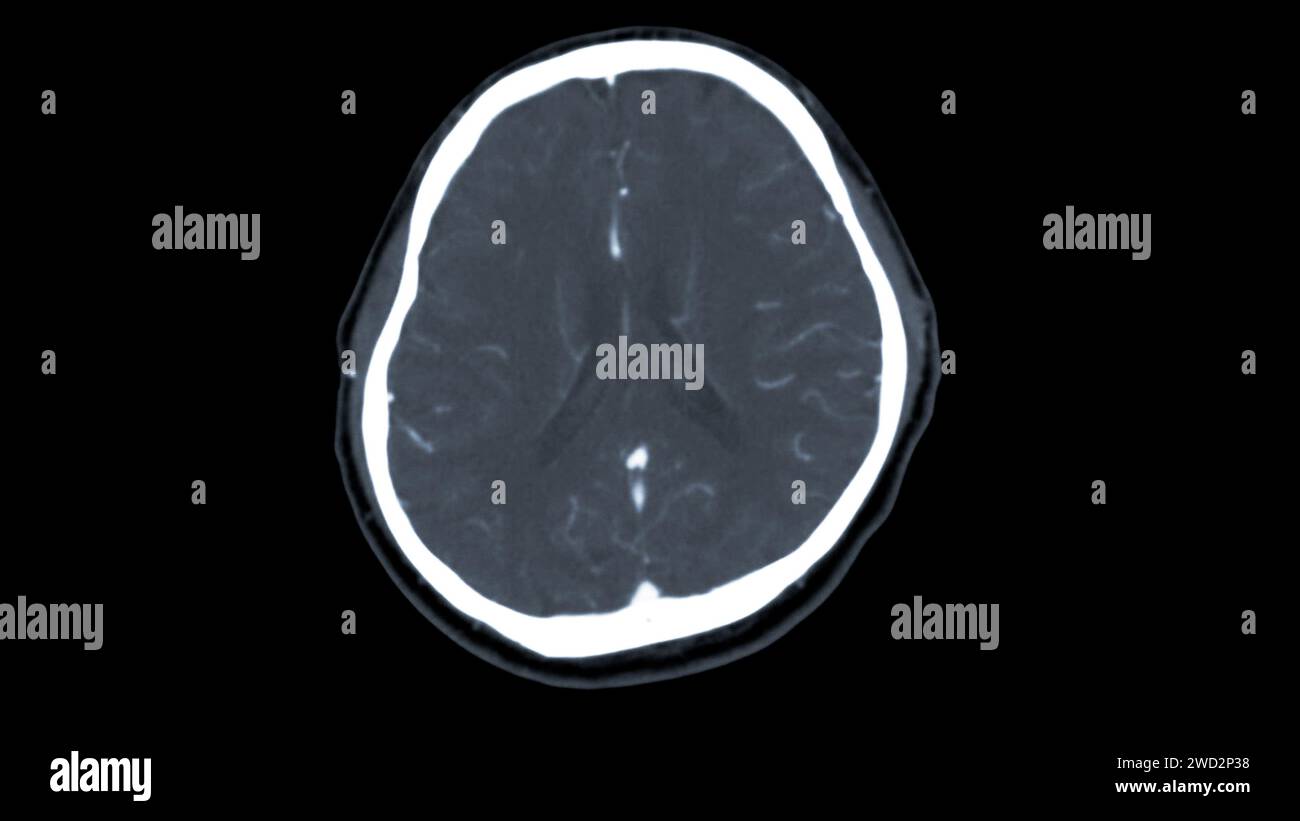 CT scan of the brain Axial view for diagnosis brain tumor,stroke ...
