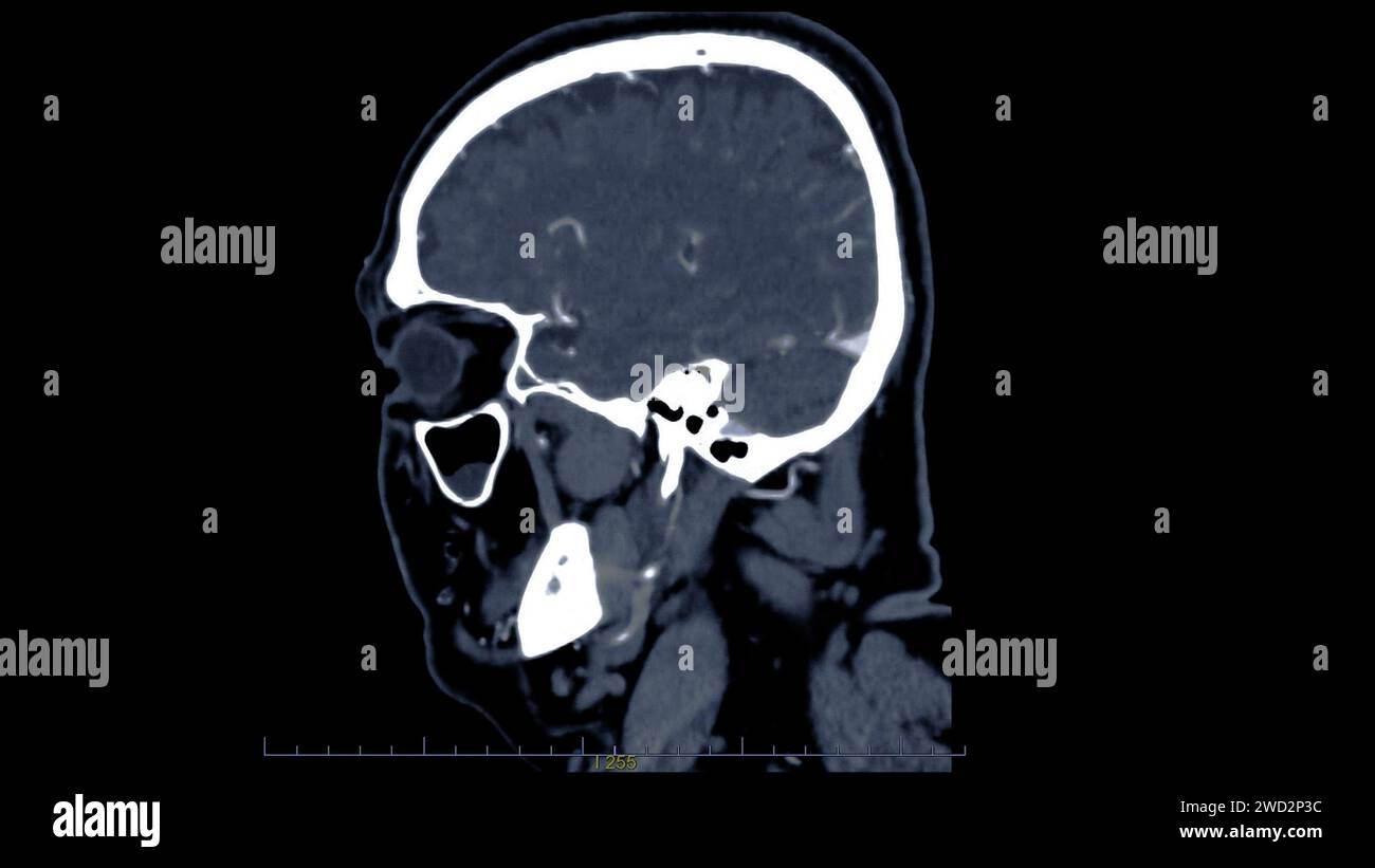 CT scan of the brain sagittal view for diagnosis brain tumor,stroke ...