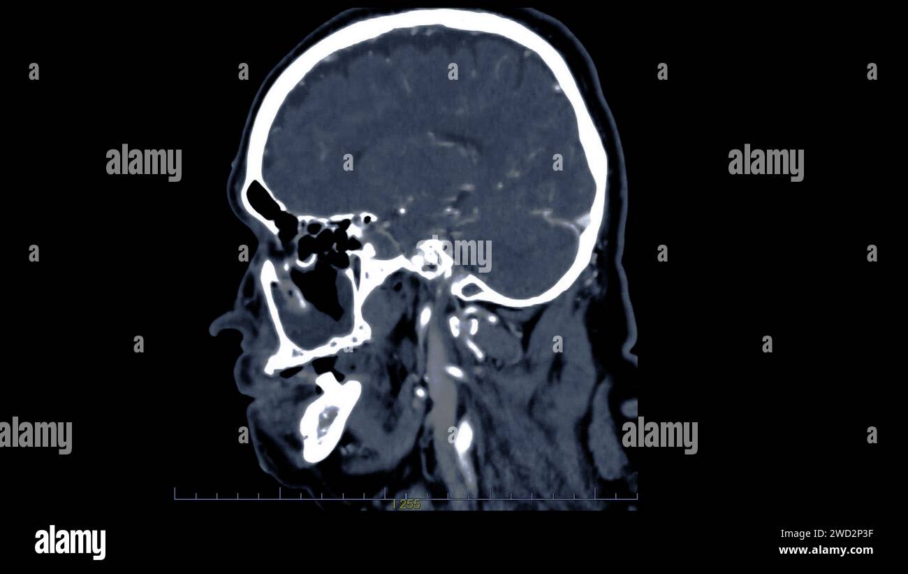 CT scan of the brain sagittal view for diagnosis brain tumor,stroke ...