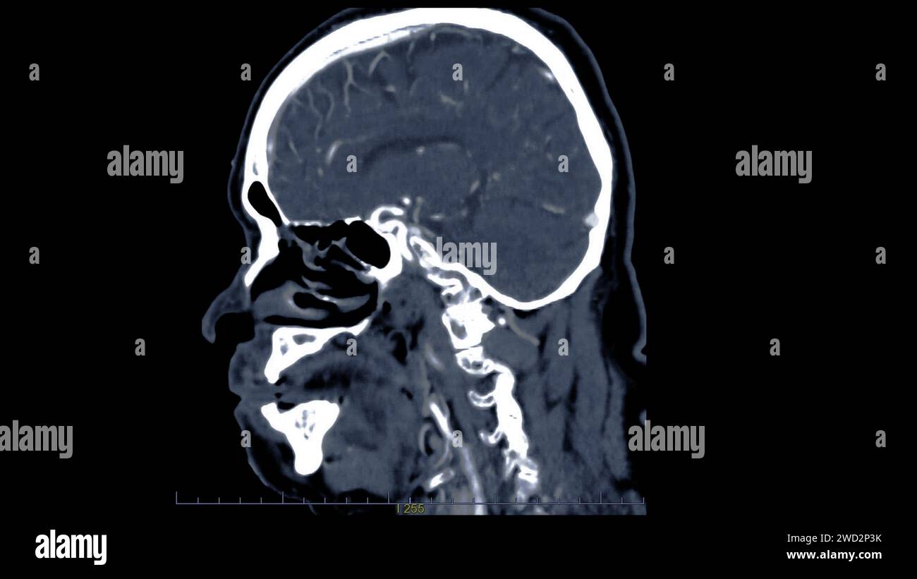CT scan of the brain sagittal view for diagnosis brain tumor,stroke ...