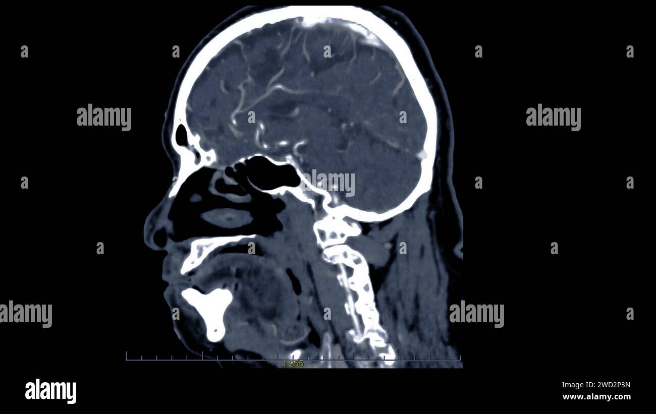 CT scan of the brain sagittal view for diagnosis brain tumor,stroke ...