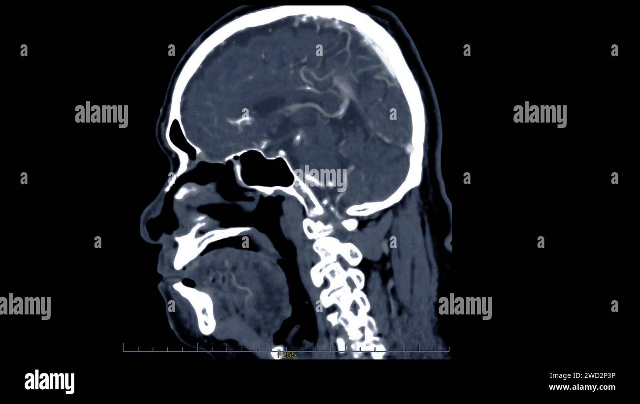 CT scan of the brain sagittal view for diagnosis brain tumor,stroke ...