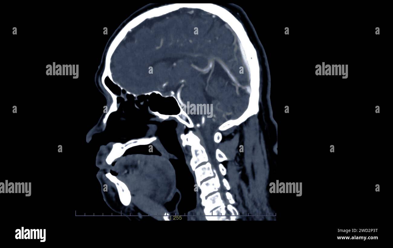 CT scan of the brain sagittal view for diagnosis brain tumor,stroke ...