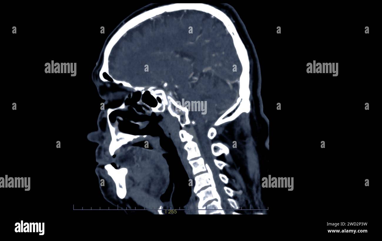 CT scan of the brain sagittal view for diagnosis brain tumor,stroke ...
