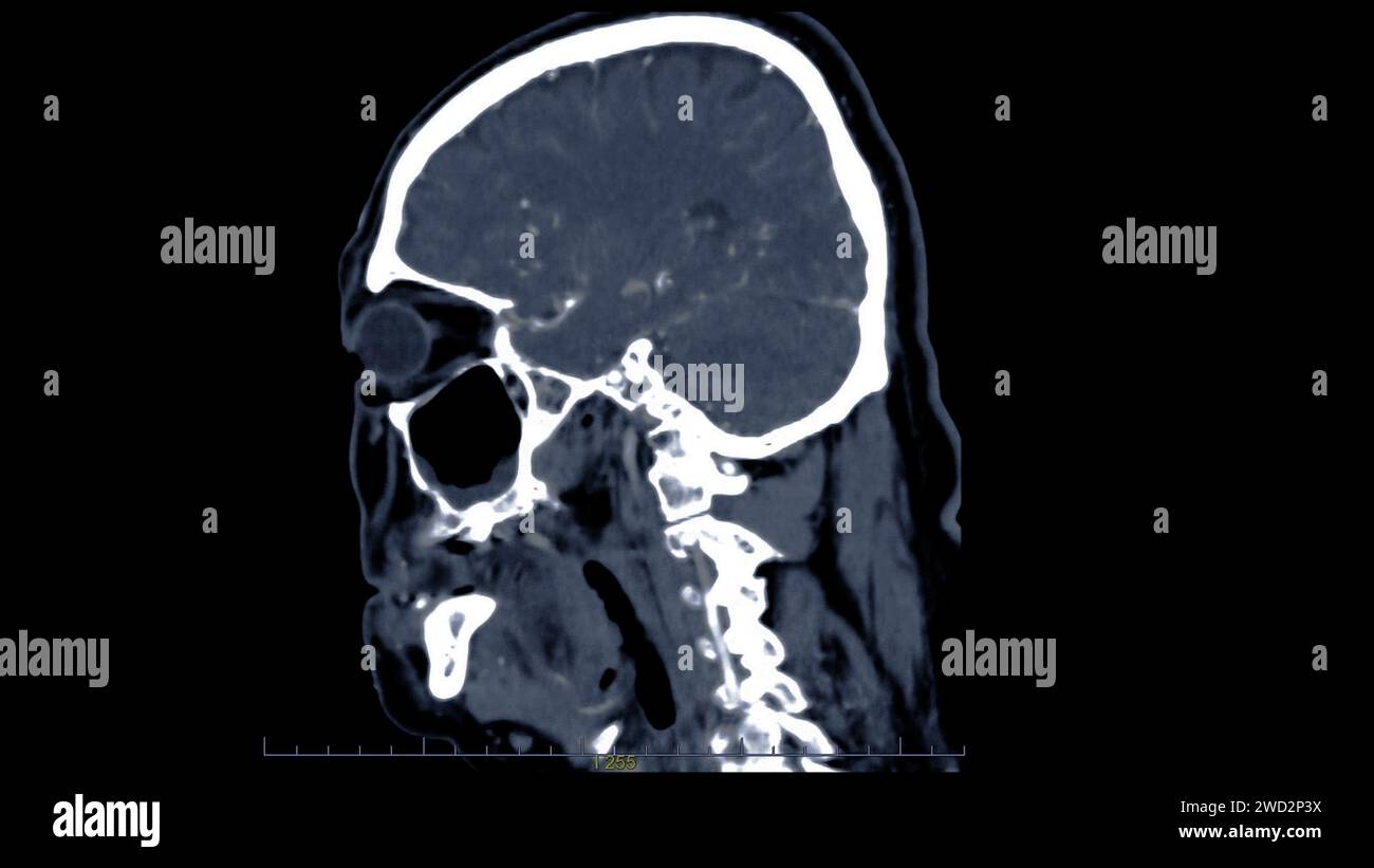 CT scan of the brain sagittal view for diagnosis brain tumor,stroke ...