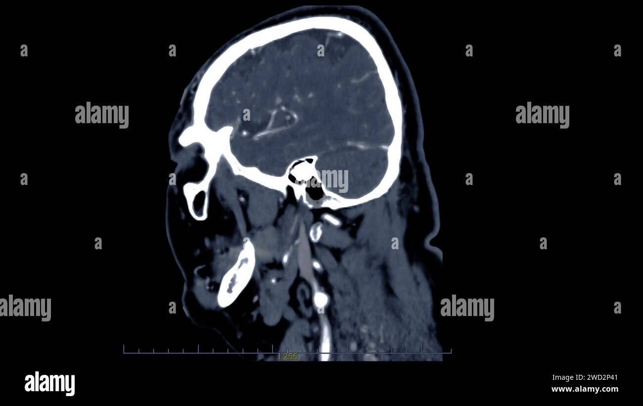 CT scan of the brain sagittal view for diagnosis brain tumor,stroke ...