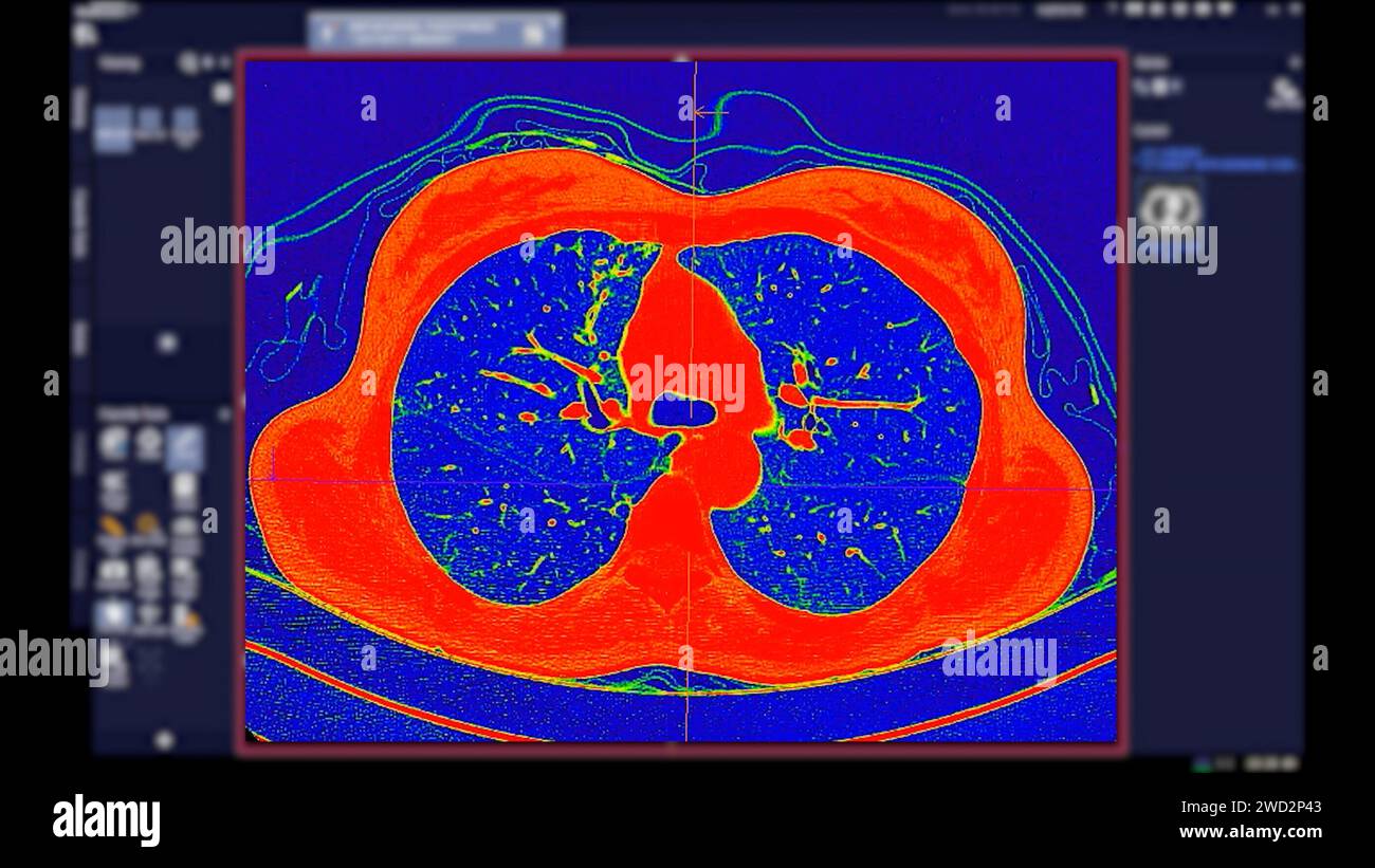 CT scan of Chest Axial view in color mode for diagnostic Pulmonary ...