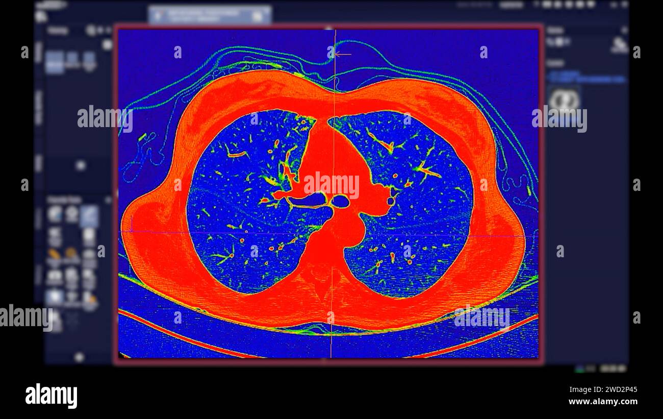 CT scan of Chest Axial view in color mode for diagnostic Pulmonary ...