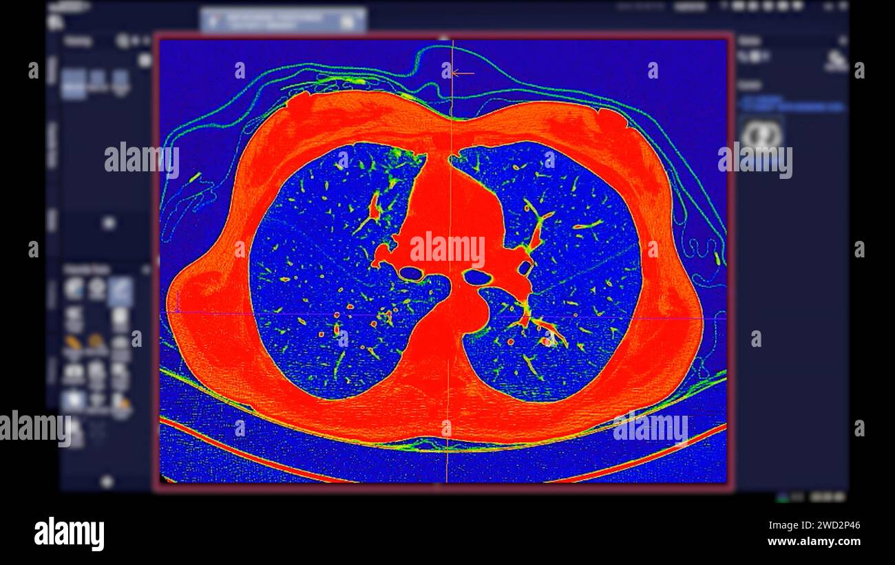 CT scan of Chest Axial view in color mode for diagnostic Pulmonary ...