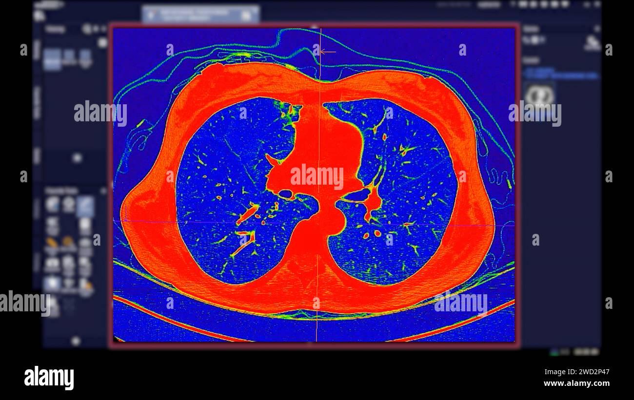 CT scan of Chest Axial view in color mode for diagnostic Pulmonary ...