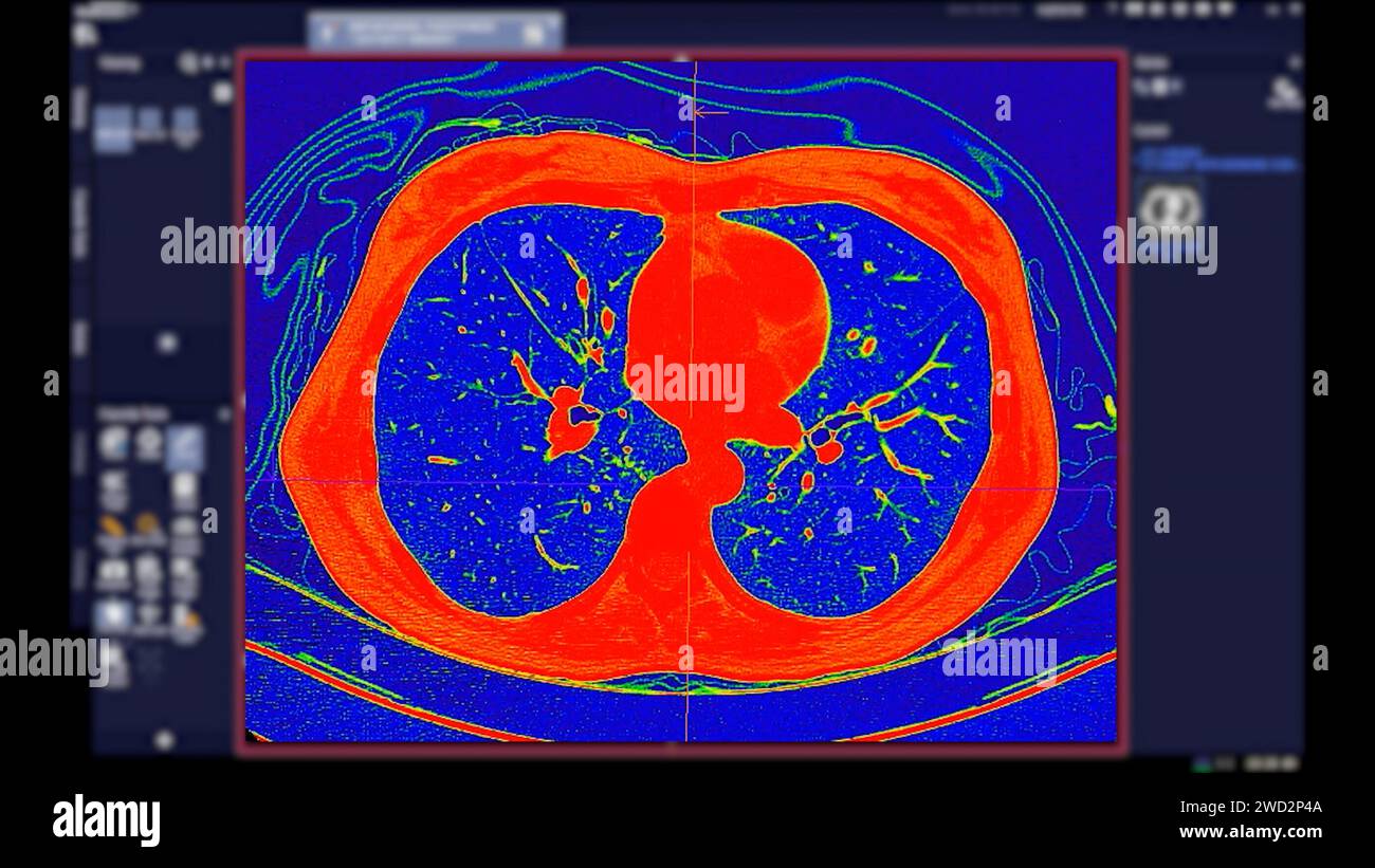 CT scan of Chest Axial view in color mode for diagnostic Pulmonary ...