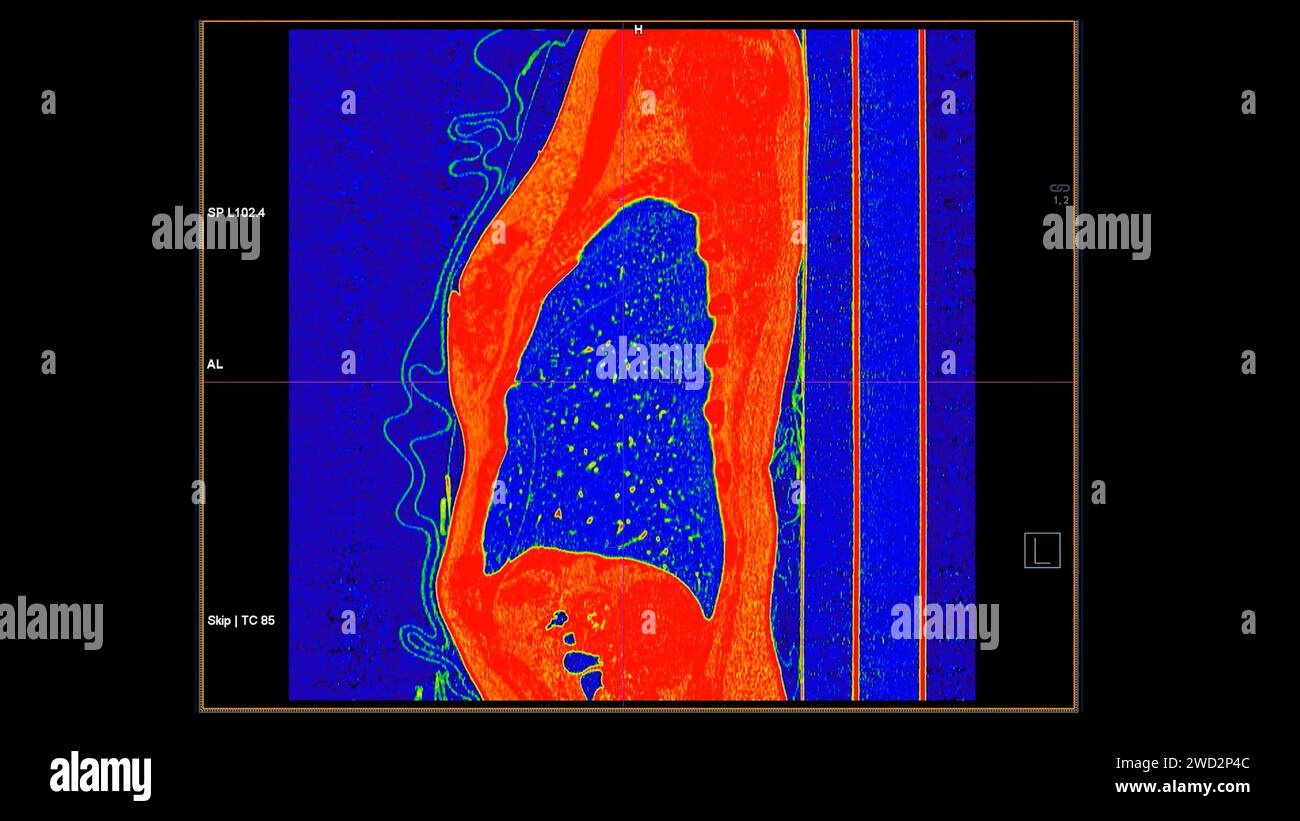 CT scan of Chest sagittal view in color mode for diagnostic Pulmonary ...