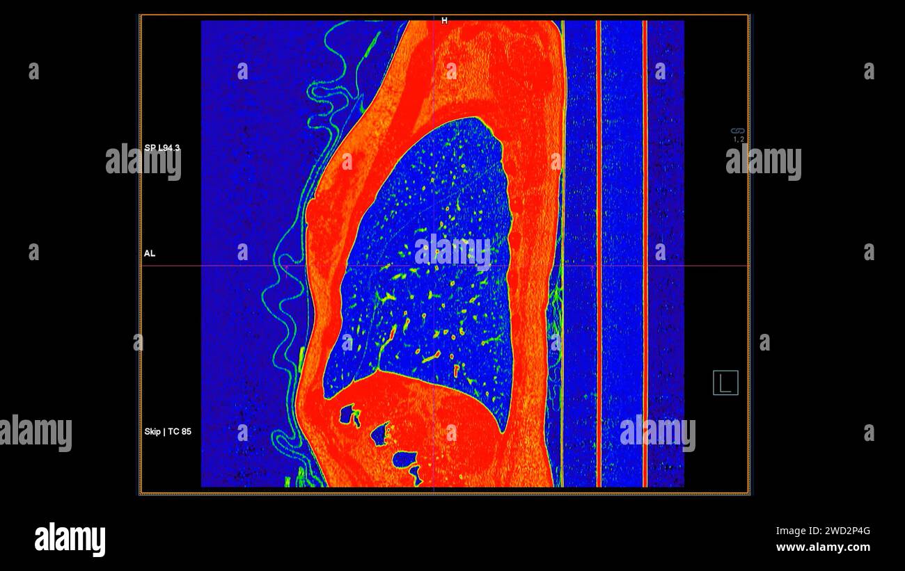 CT scan of Chest sagittal view in color mode for diagnostic Pulmonary ...