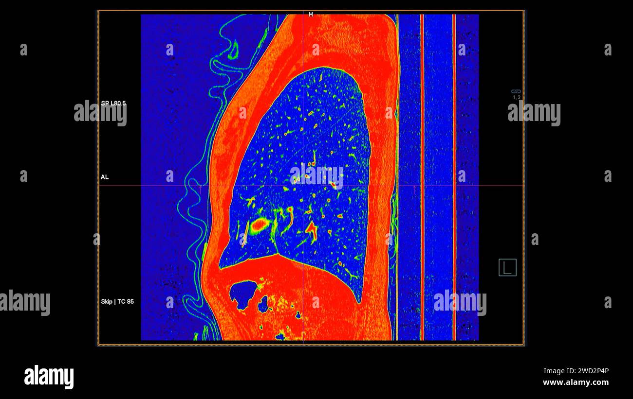 CT scan of Chest sagittal view in color mode for diagnostic Pulmonary ...