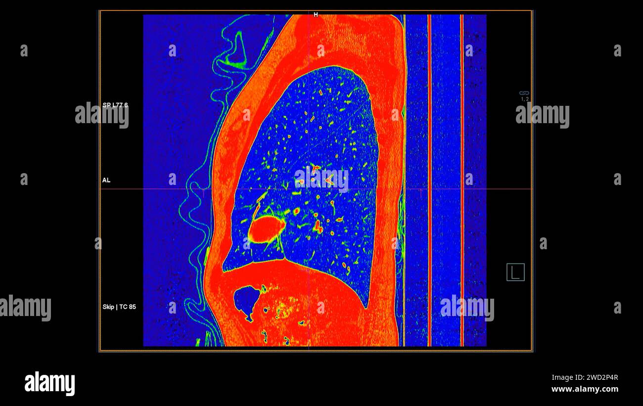 CT scan of Chest sagittal view in color mode for diagnostic Pulmonary ...