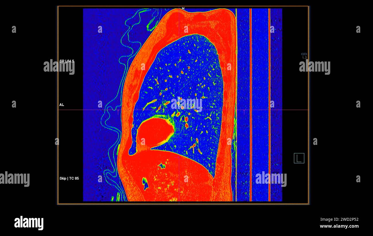 CT scan of Chest sagittal view in color mode for diagnostic Pulmonary ...