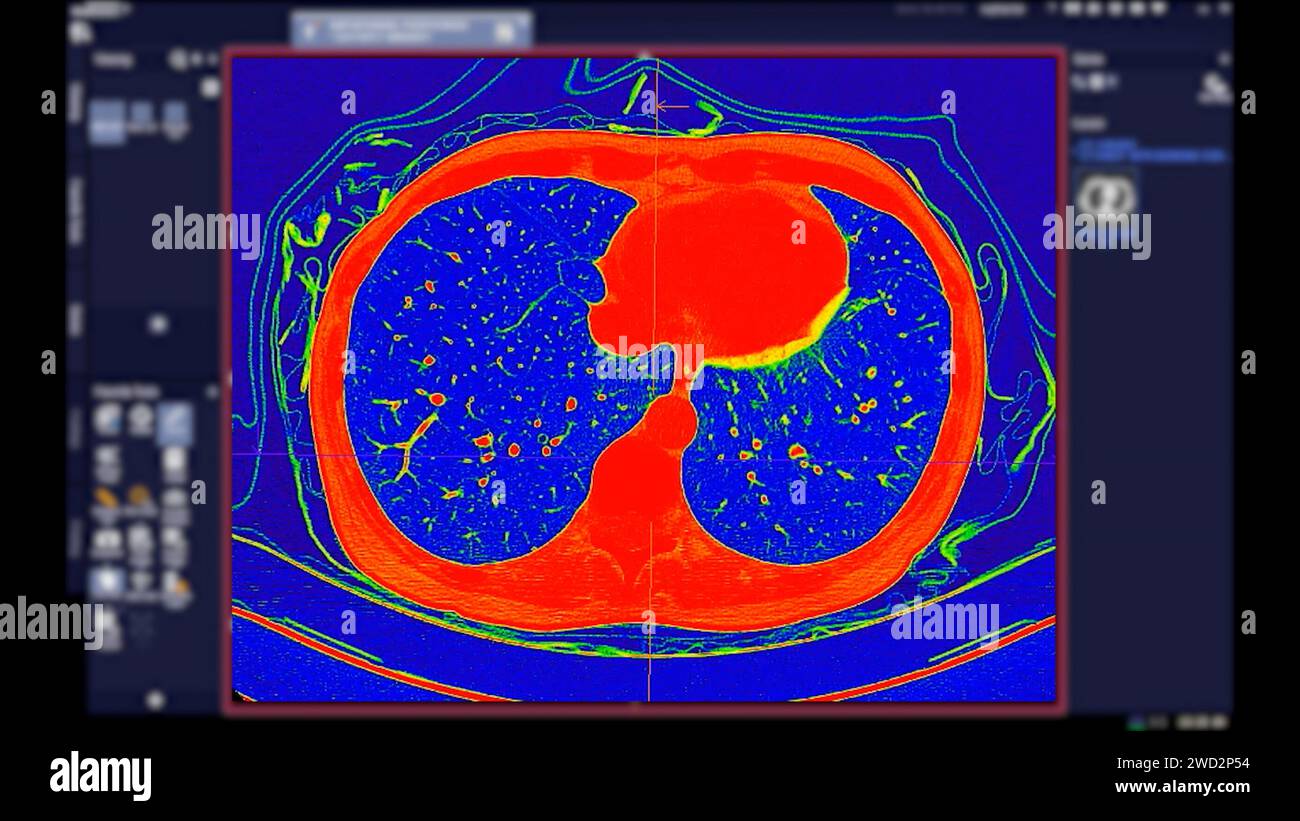 CT scan of Chest Axial view in color mode for diagnostic Pulmonary ...