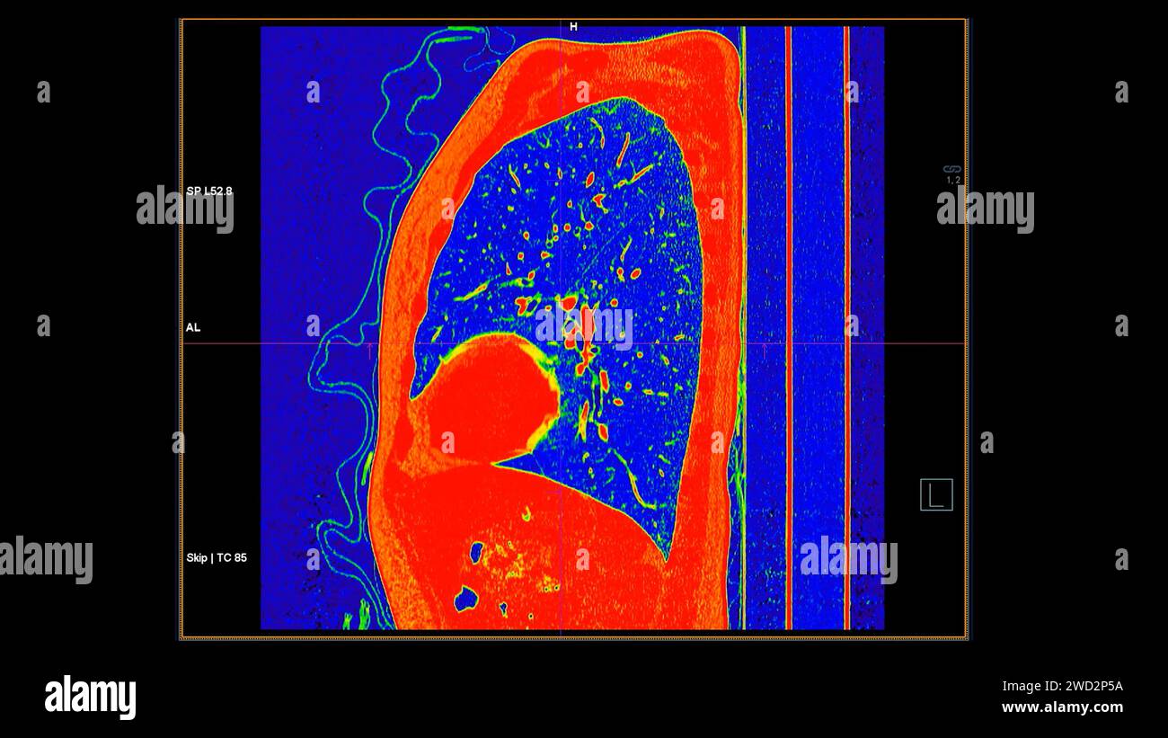 CT scan of Chest sagittal view in color mode for diagnostic Pulmonary ...