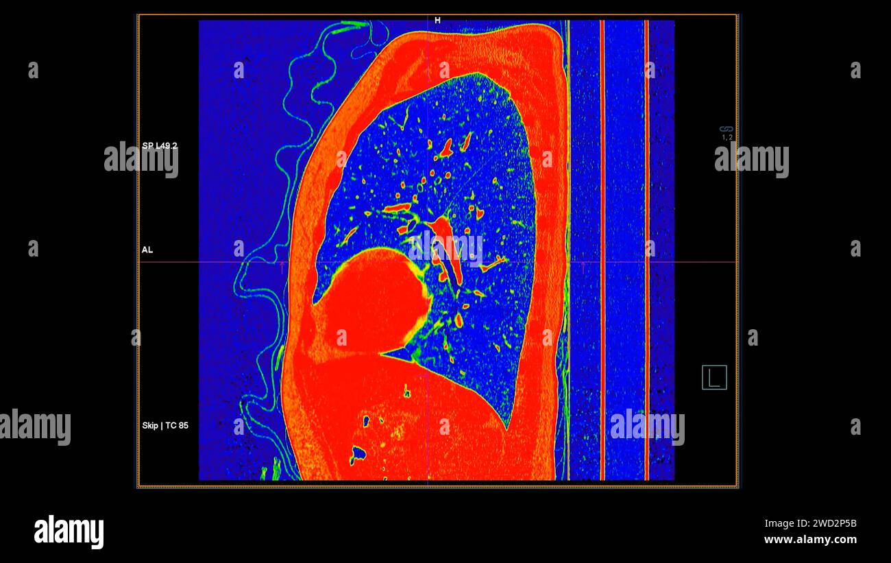 CT scan of Chest sagittal view in color mode for diagnostic Pulmonary ...