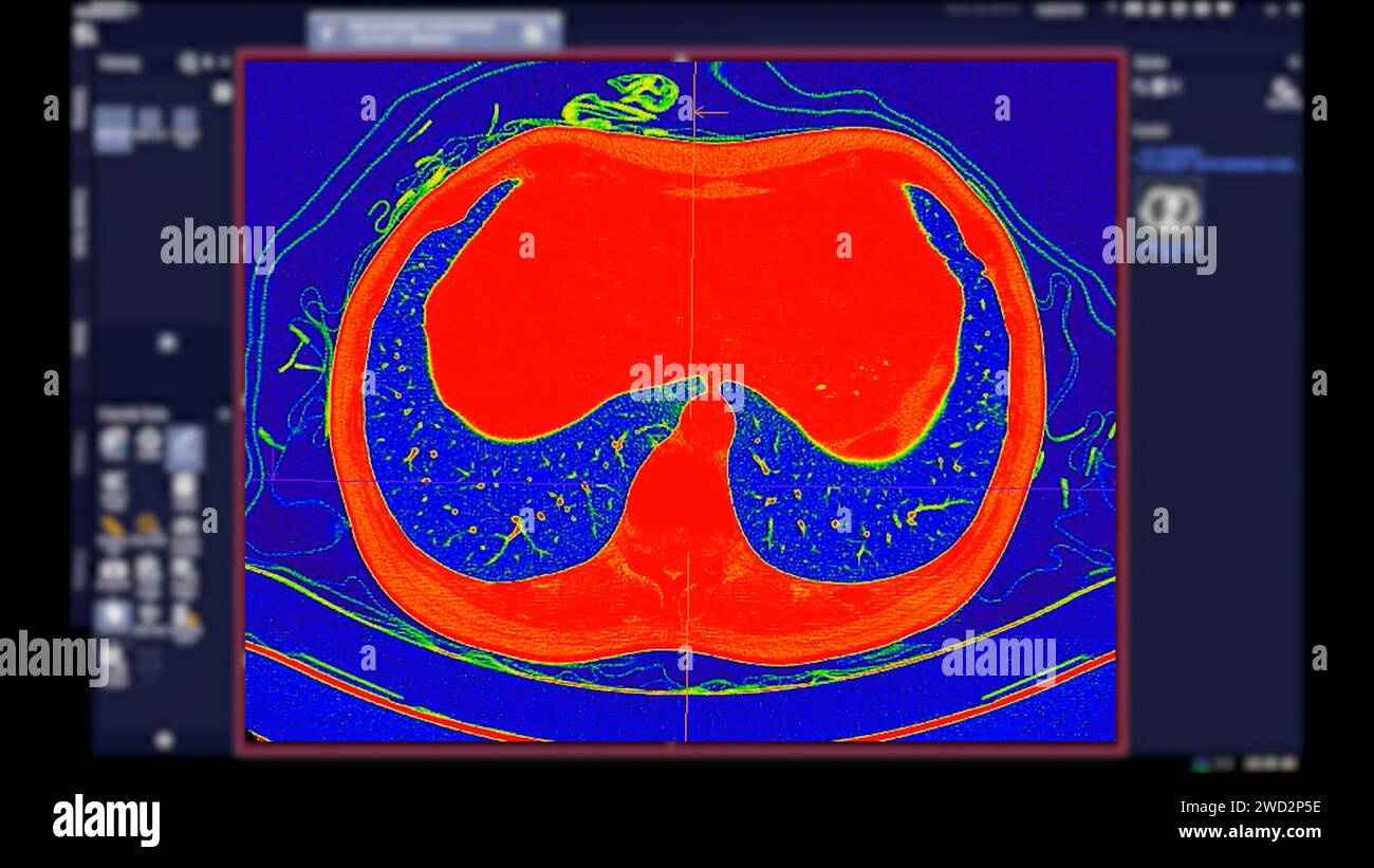CT scan of Chest Axial view in color mode for diagnostic Pulmonary ...
