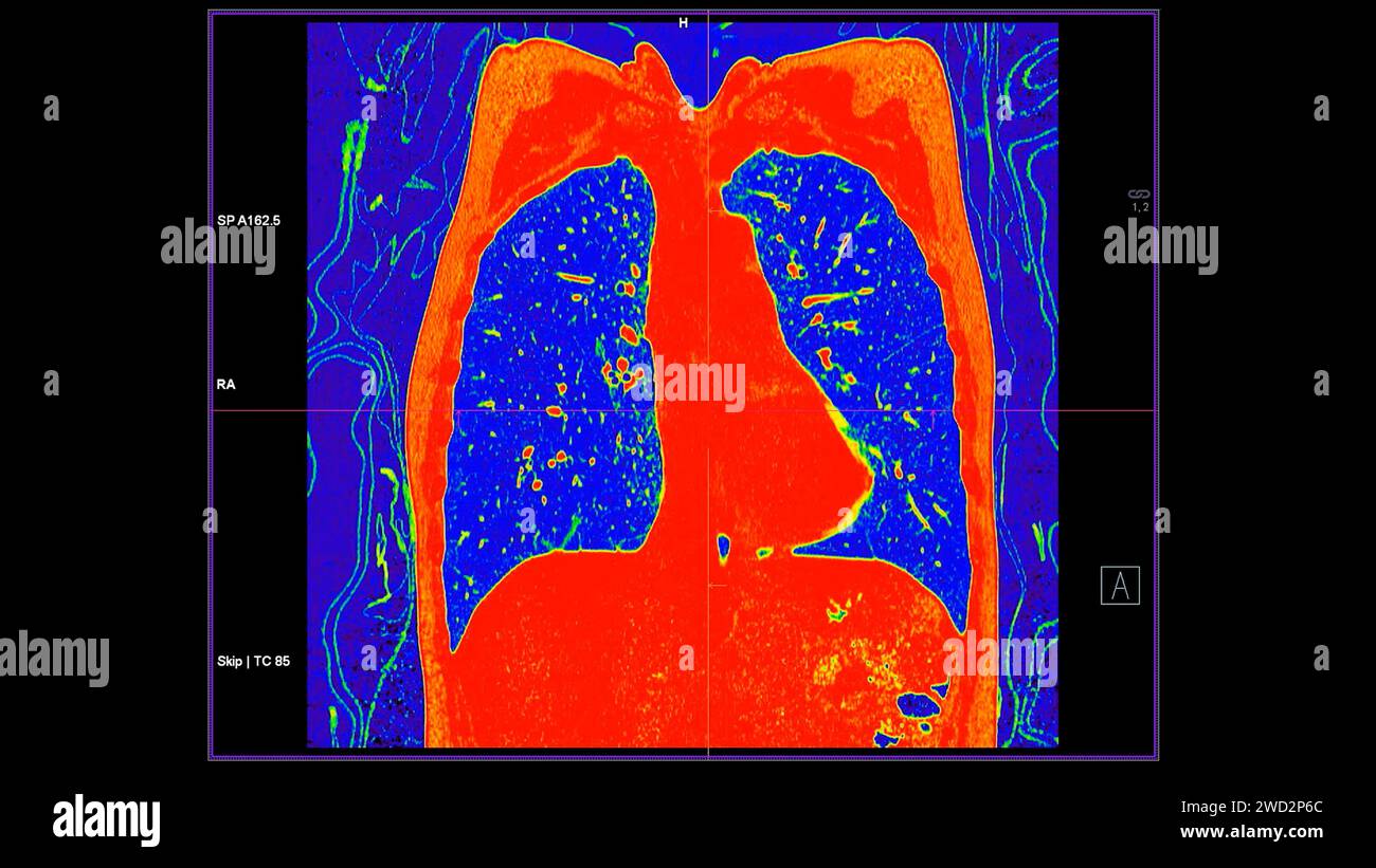 CT scan of Chest coronal view in color mode for diagnostic Pulmonary ...