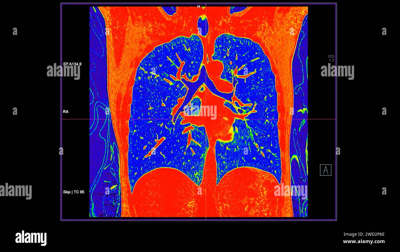 CT scan of Chest coronal view in color mode for diagnostic Pulmonary ...