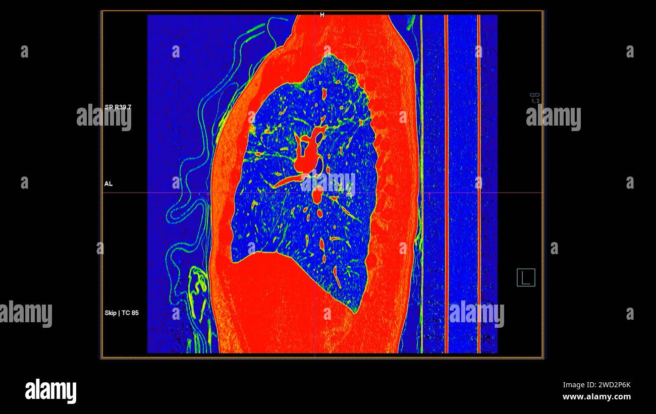CT scan of Chest sagittal view in color mode for diagnostic Pulmonary ...
