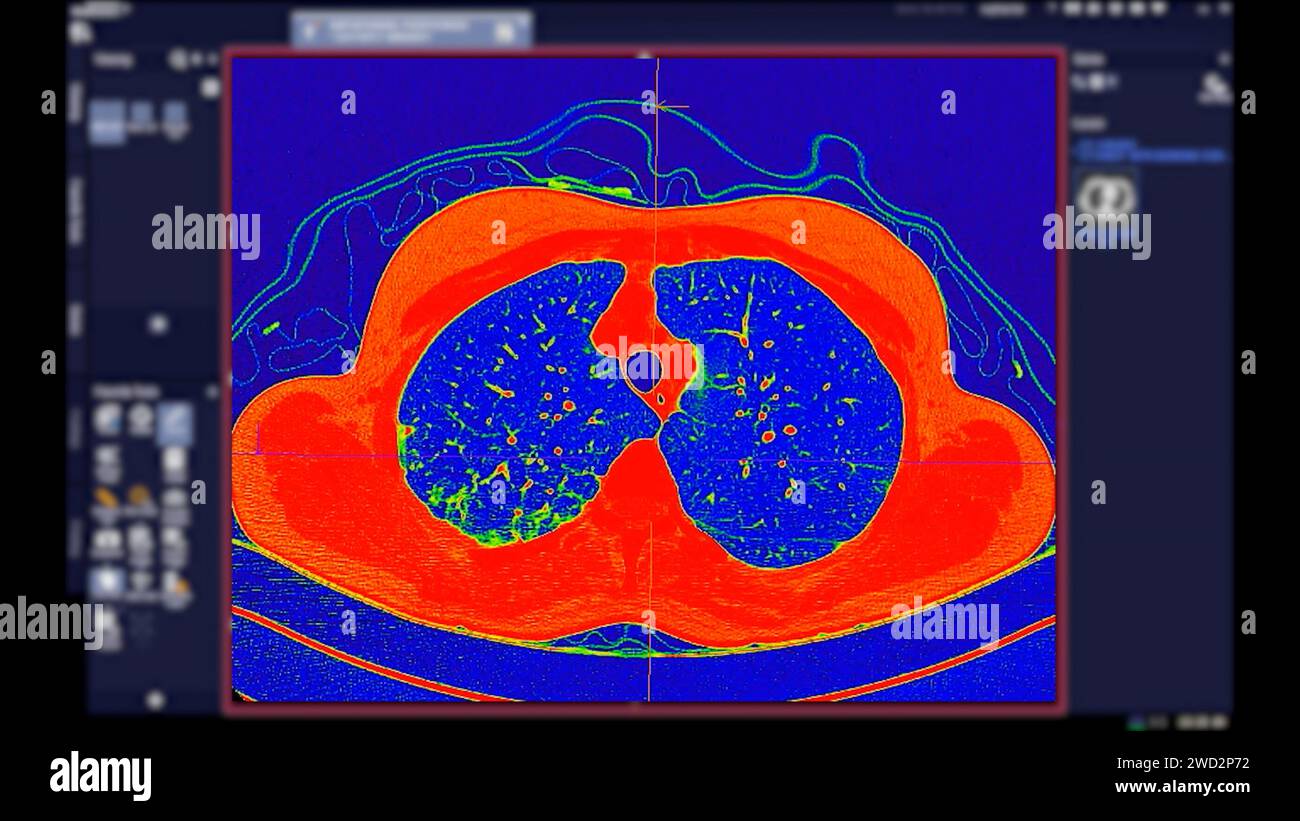 CT scan of Chest Axial view in color mode for diagnostic Pulmonary ...