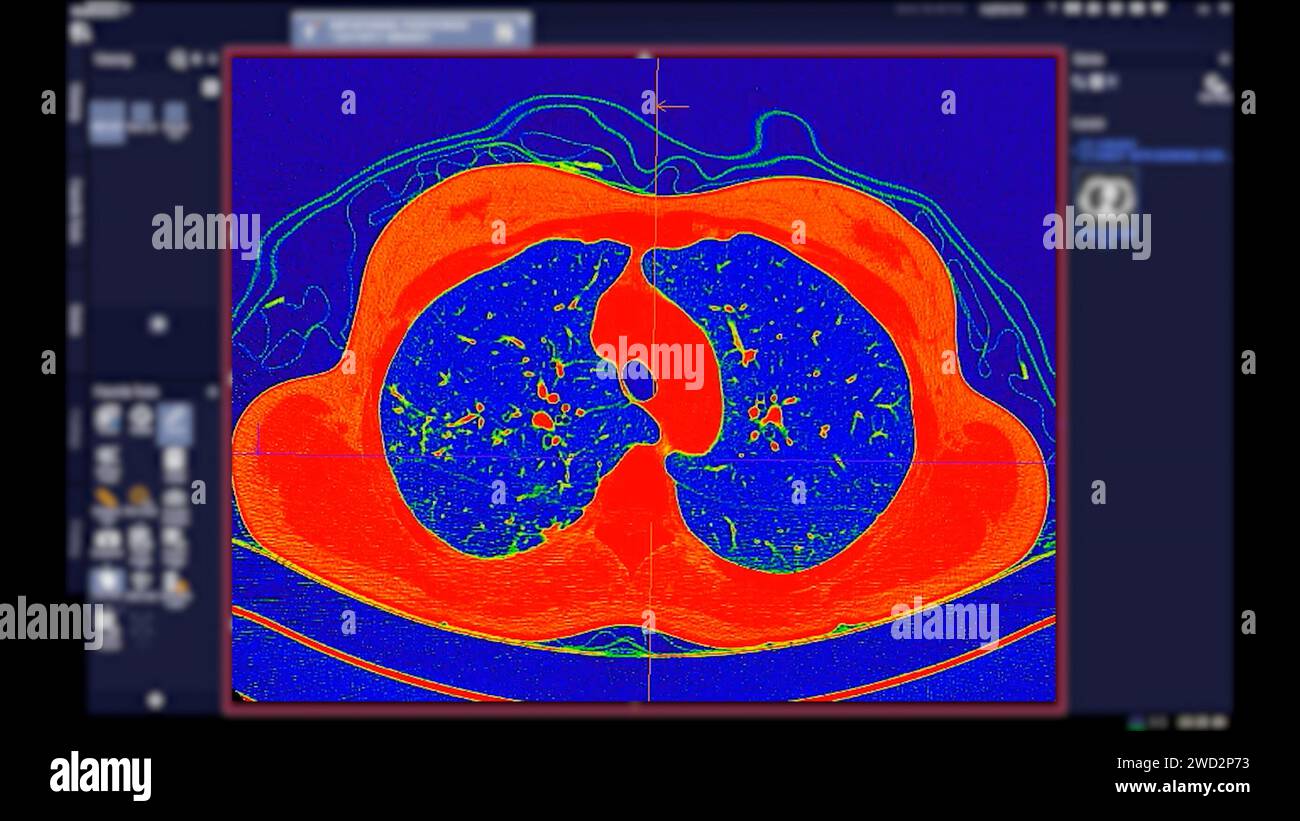 CT scan of Chest Axial view in color mode for diagnostic Pulmonary ...