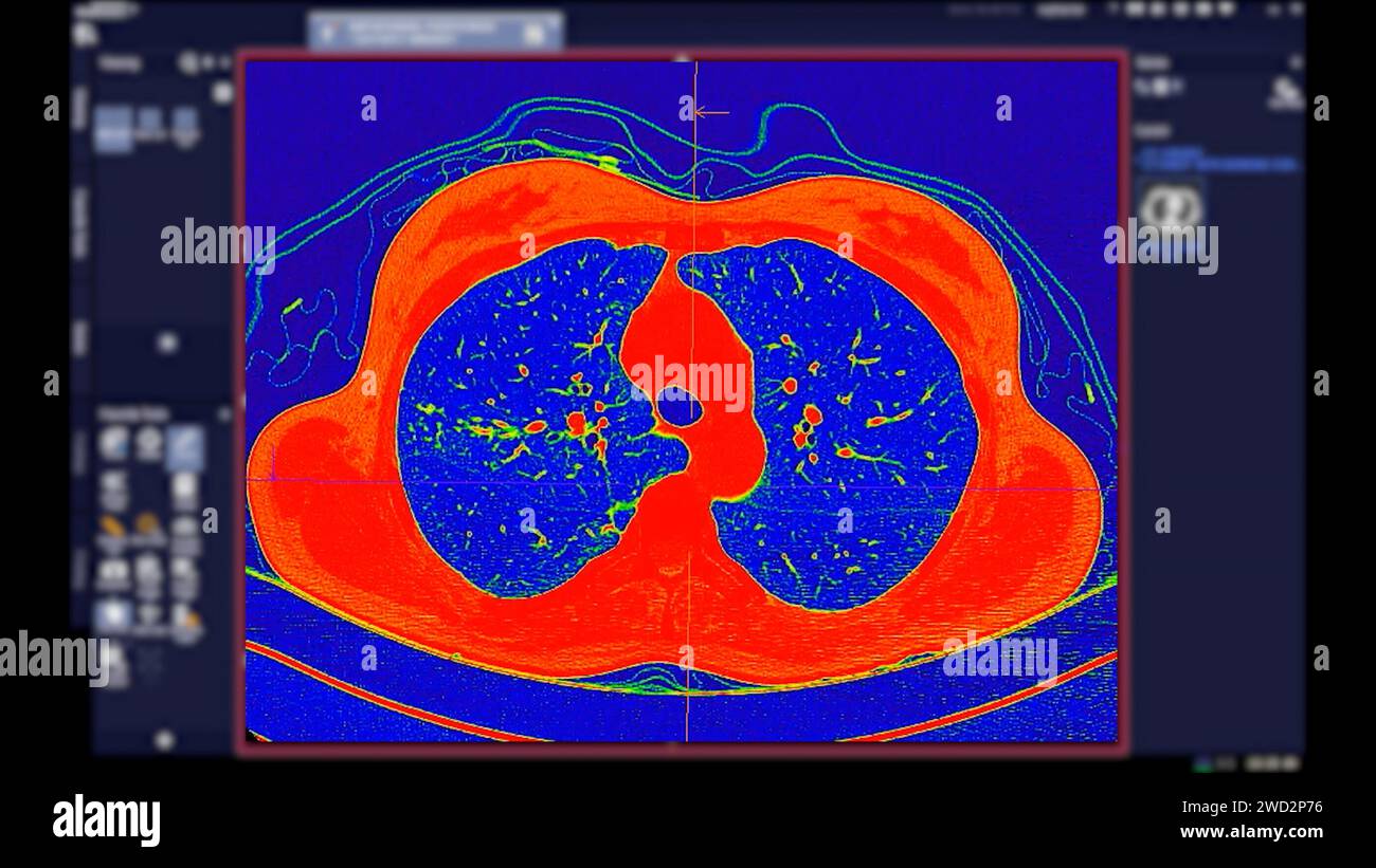 CT scan of Chest Axial view in color mode for diagnostic Pulmonary ...