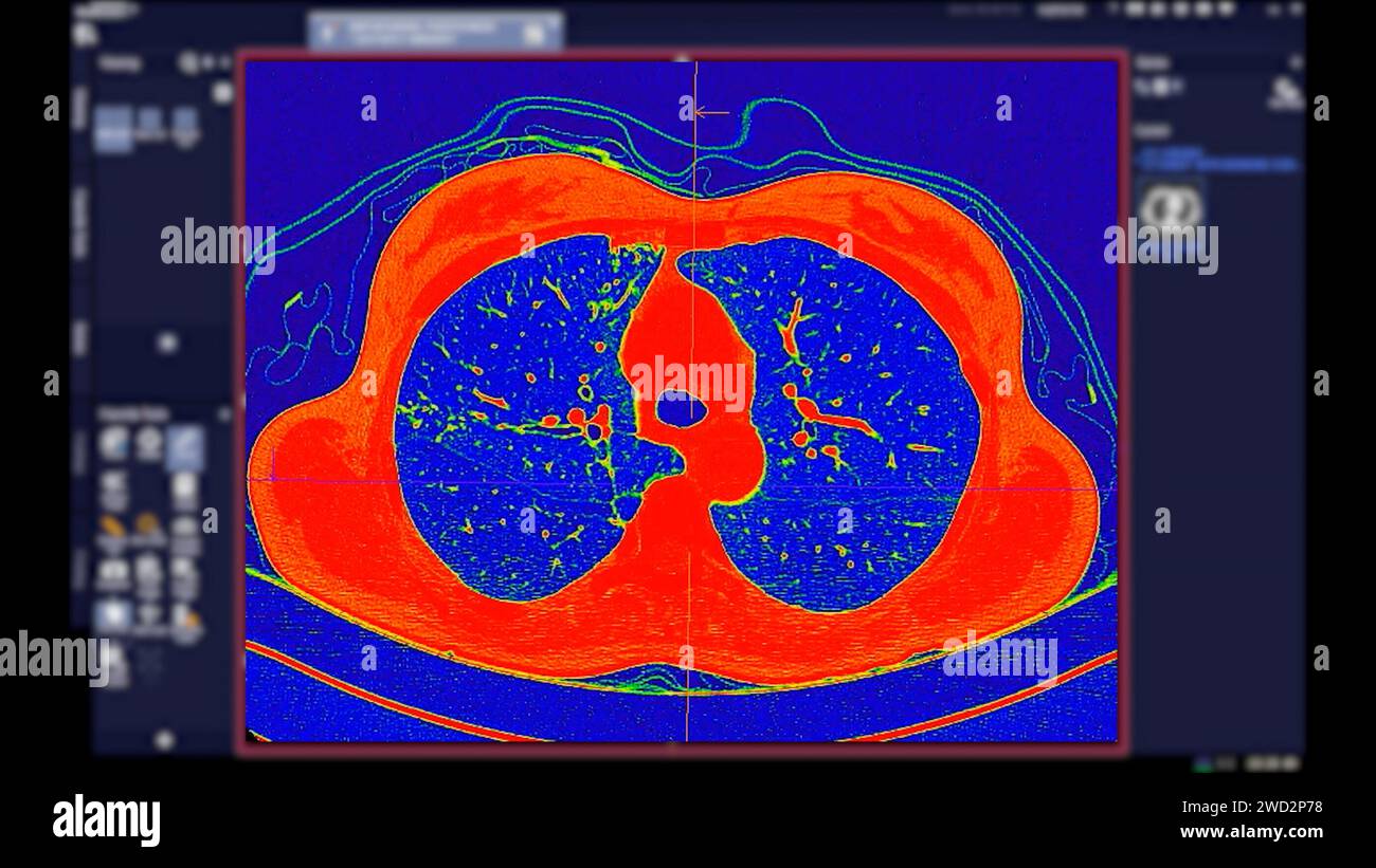 CT scan of Chest Axial view in color mode for diagnostic Pulmonary ...