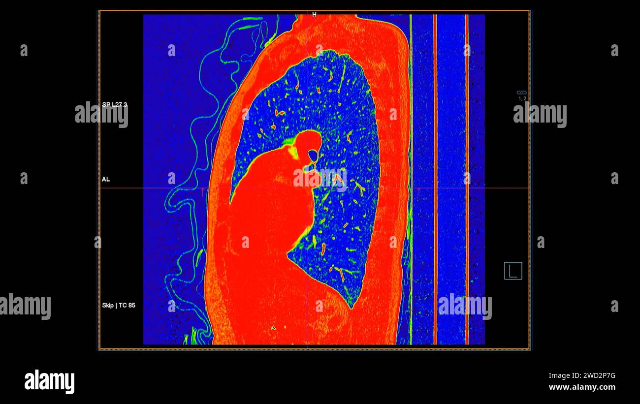 CT scan of Chest coronal view in color mode for diagnostic Pulmonary ...