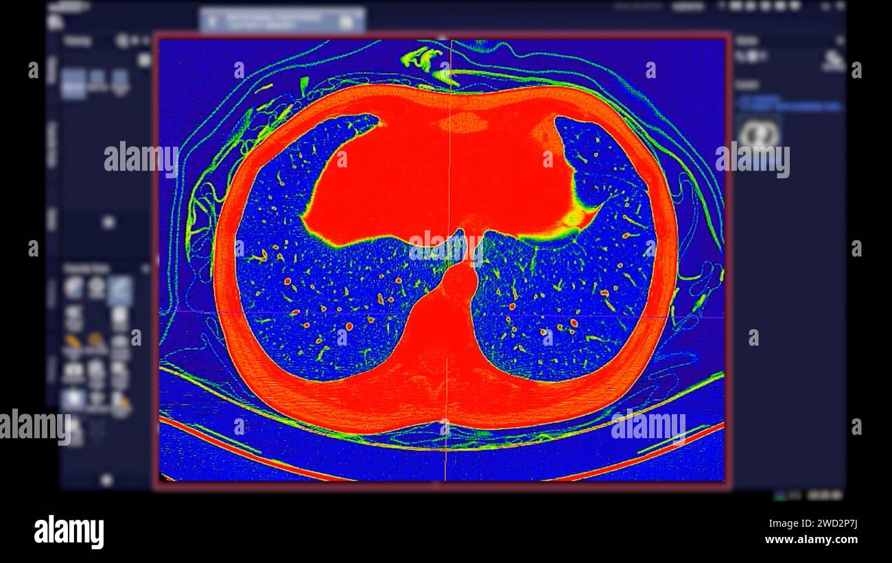 CT scan of Chest Axial view in color mode for diagnostic Pulmonary ...