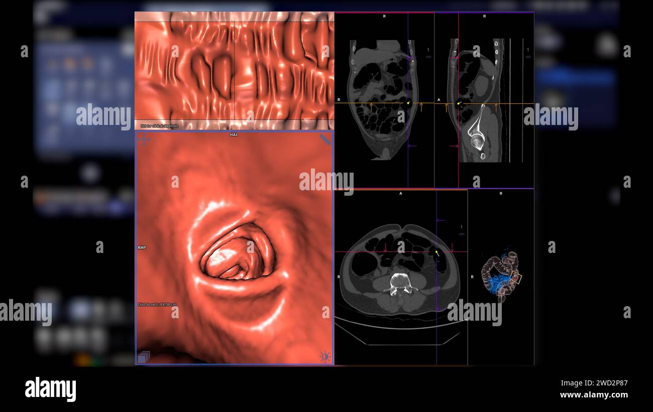 CT colonography , This imaging technique is often employed for ...
