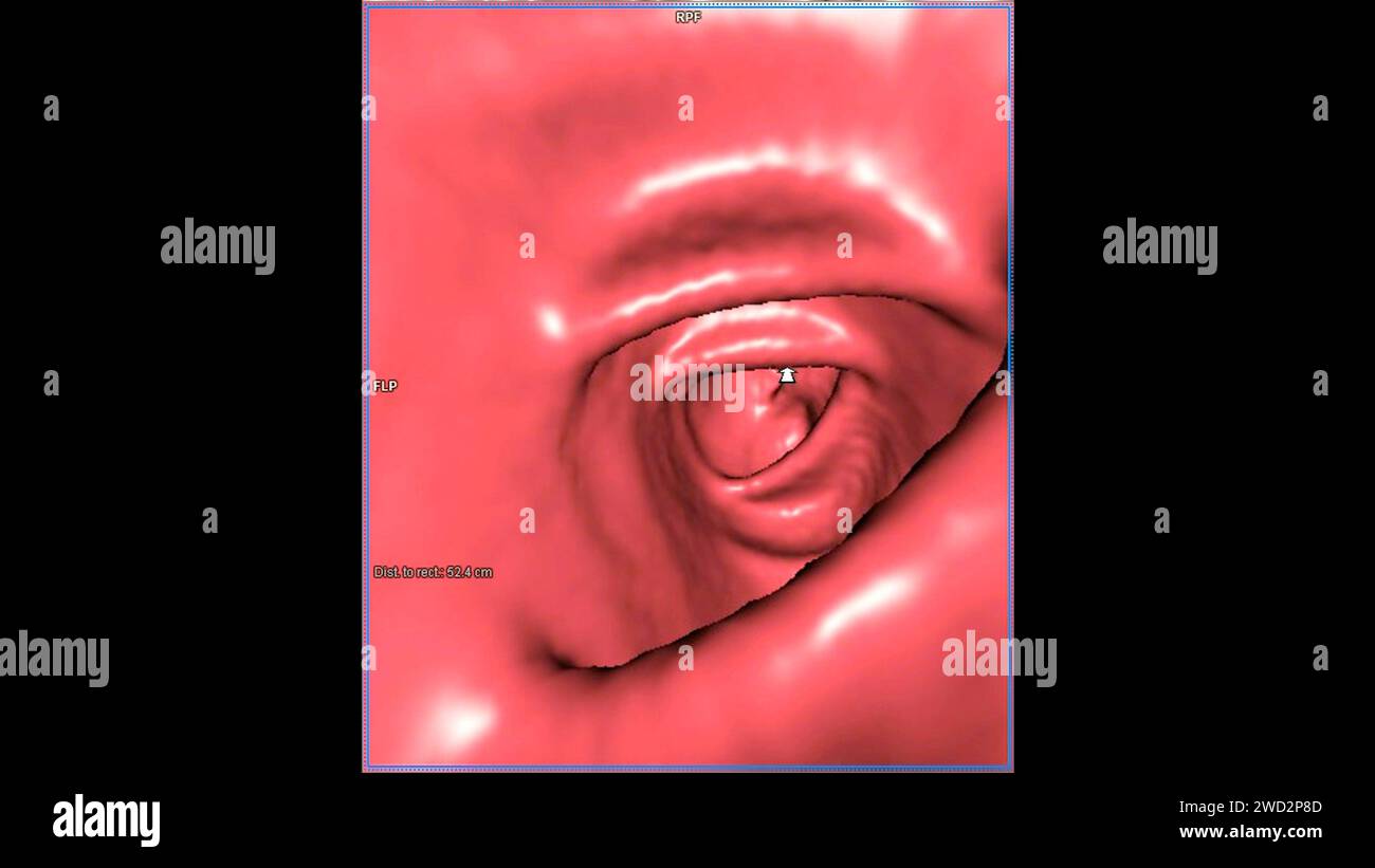 CT colonography , This imaging technique is often employed for ...