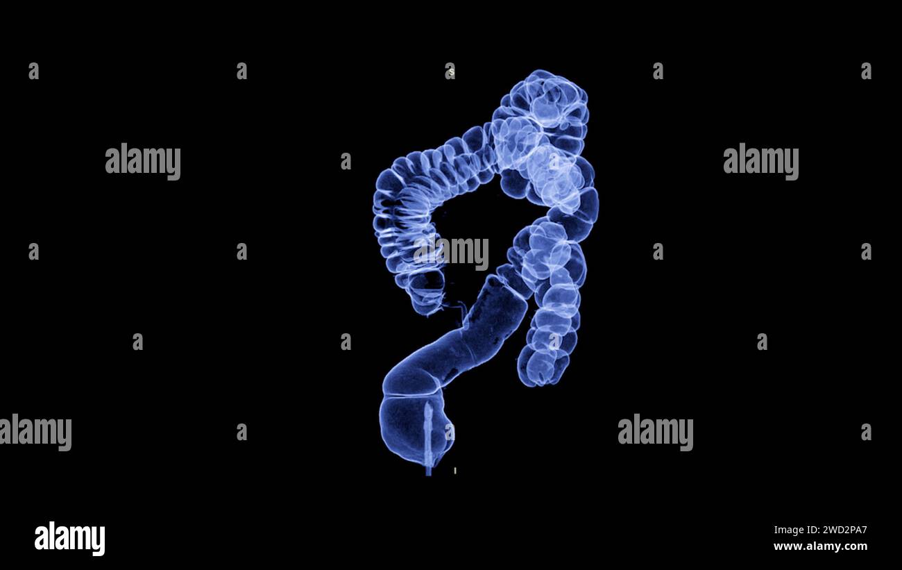 Large intestine diverticulitis hi-res stock photography and images - Alamy